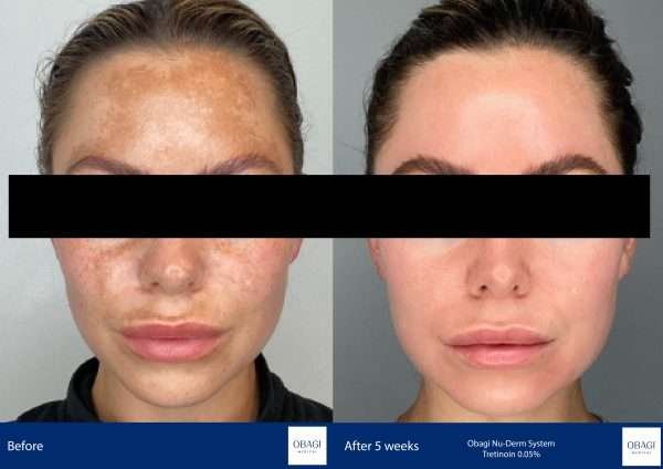 Simple steps to prevent and reduce skin hyperpigmentation | KEEM ...